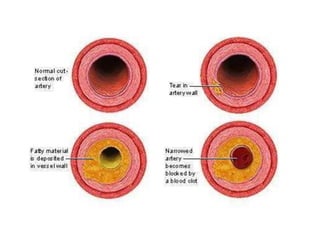 Intracell accumulation final | PPTX