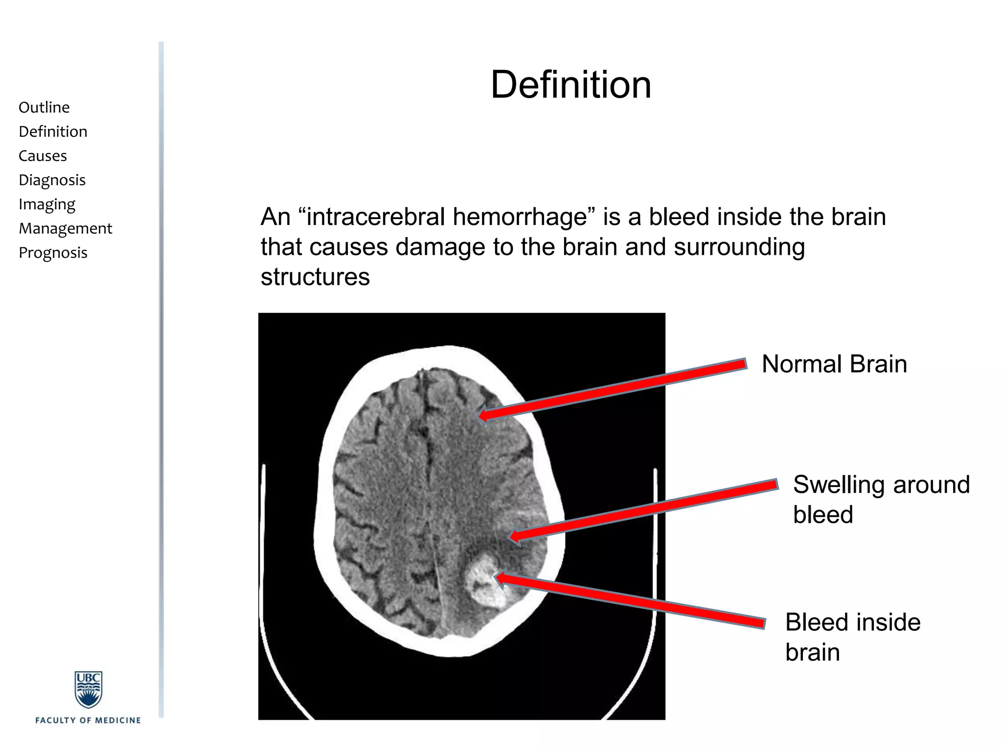 Intracerebral hemorrhage info for patients and families | PPTX | Blood Disorders | Diseases and ...