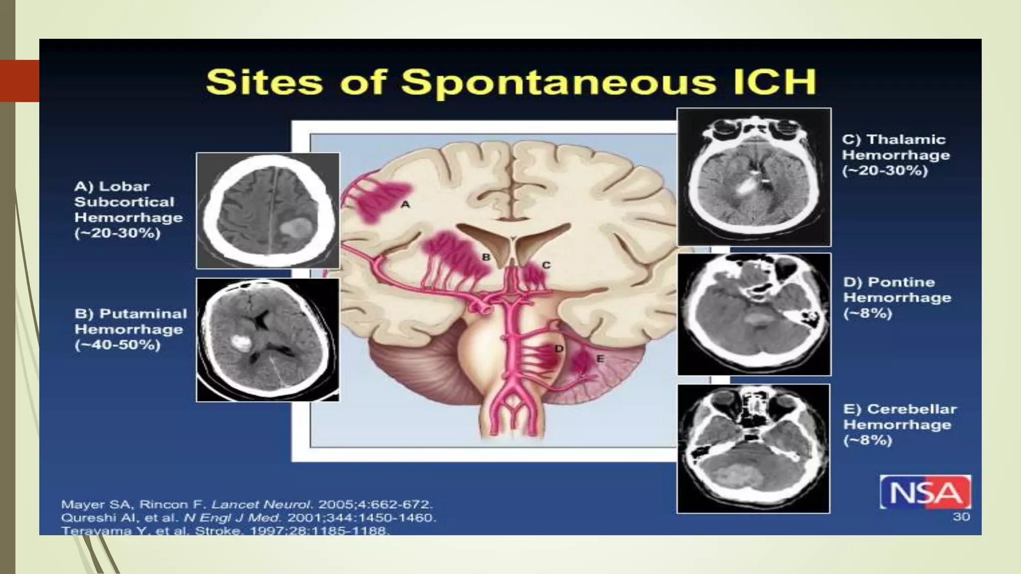 Intracerebral hemorrhage, SAH, ischemic stroke,[412].pptx