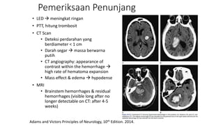intracerebral hemorrhage& subaracnoid.pptx