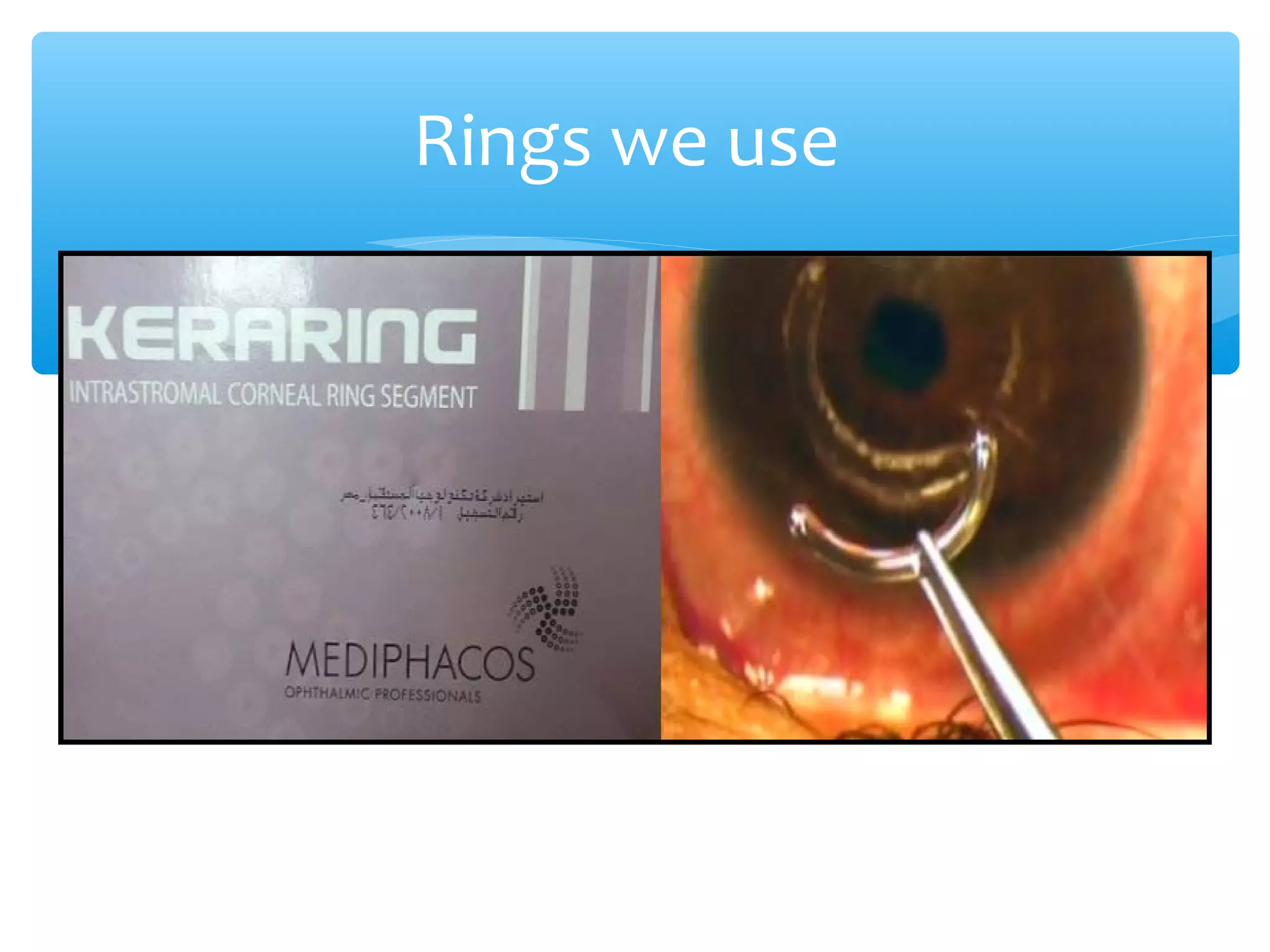 Intracorneal ring-segments-by-femtosecond-tunnel-creation | PPT