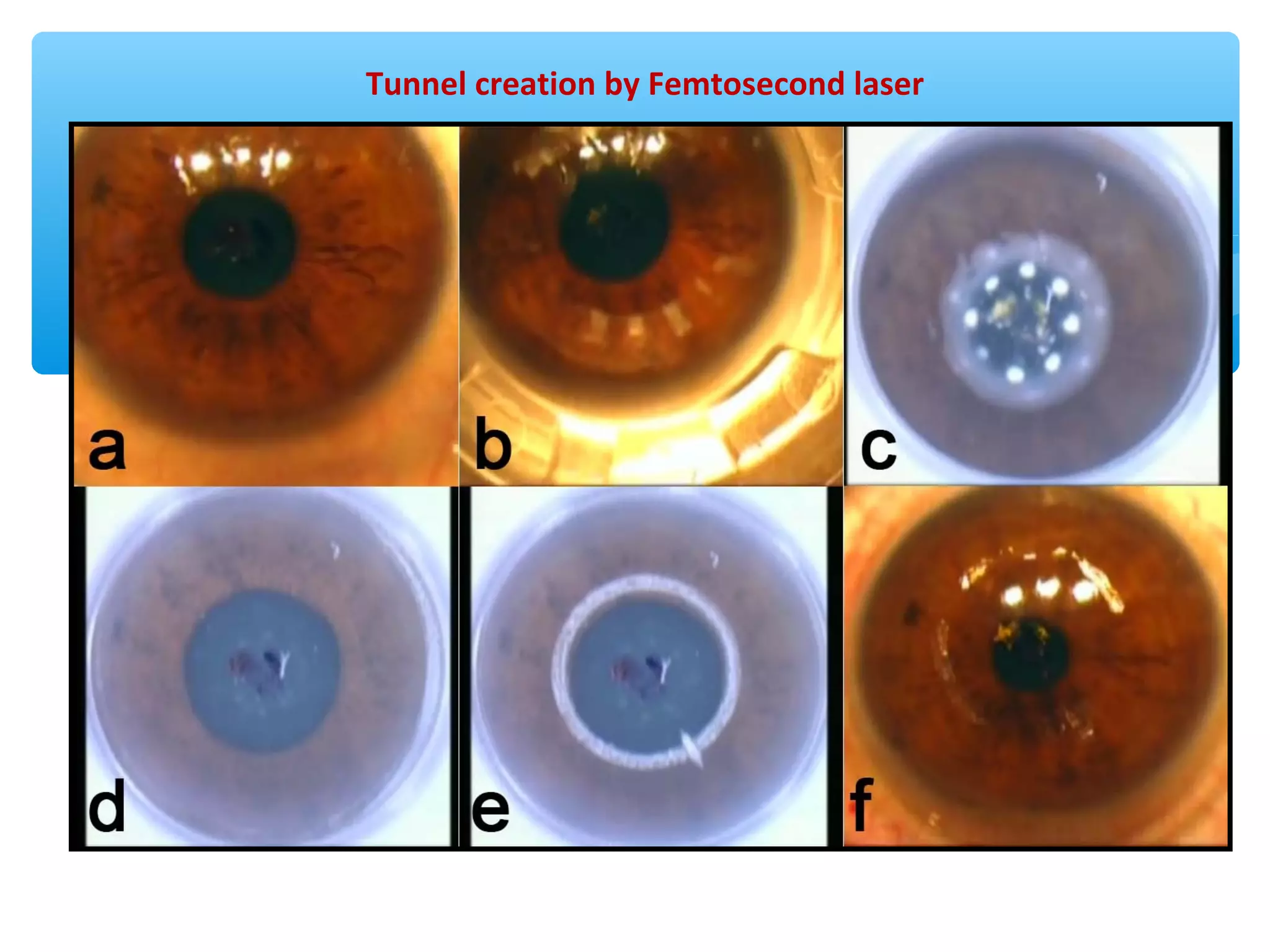 Intracorneal ring-segments-by-femtosecond-tunnel-creation | PPT
