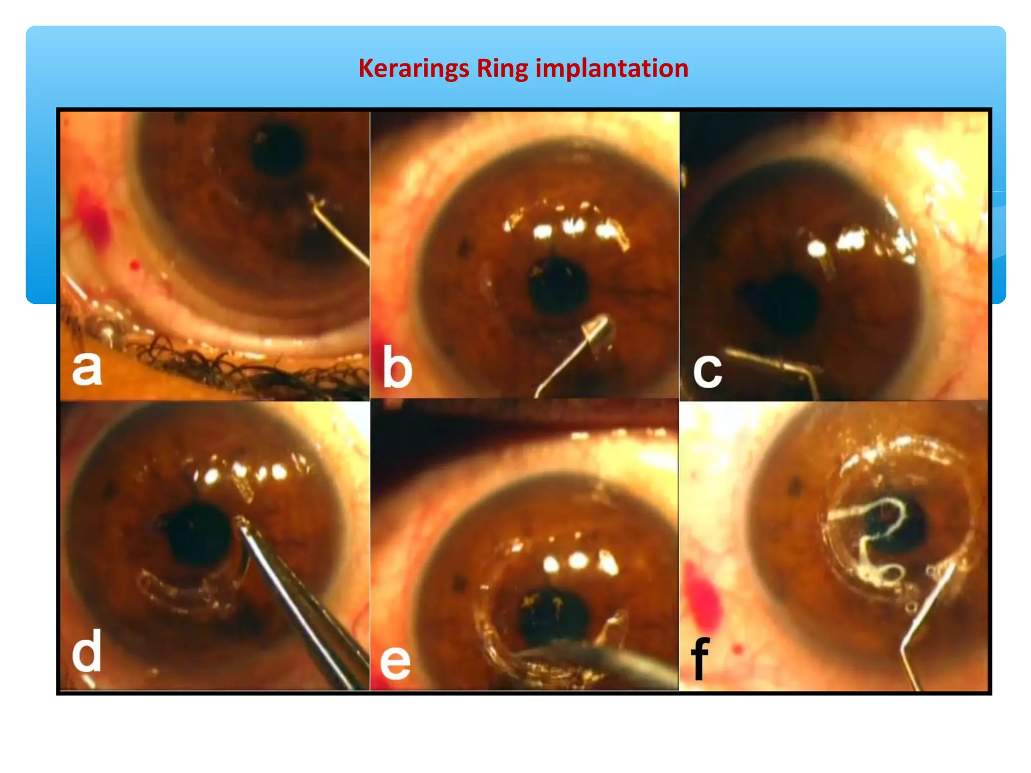 Intracorneal ring-segments-by-femtosecond-tunnel-creation | PPT