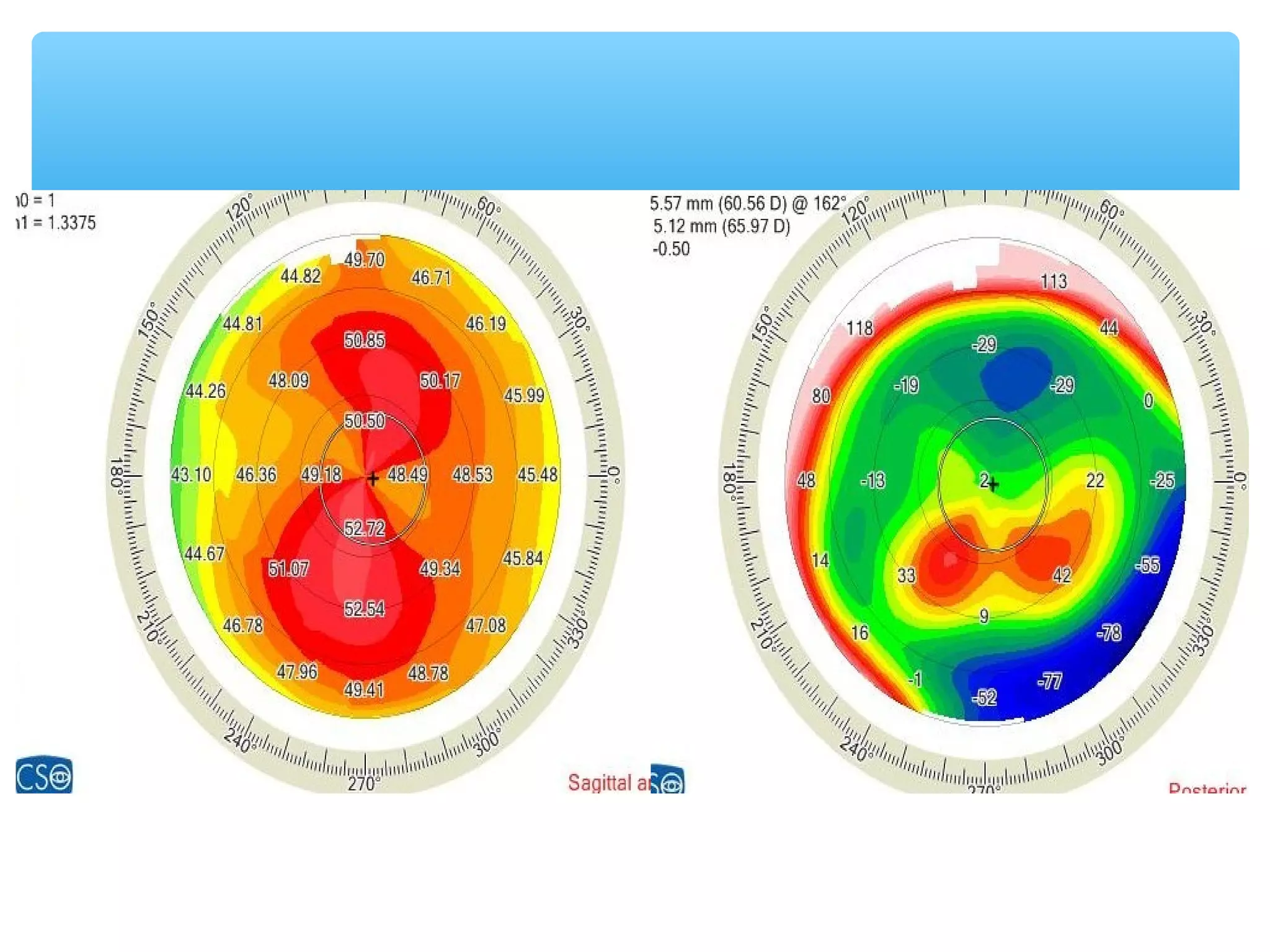 Intracorneal ring-segments-by-femtosecond-tunnel-creation | PPT