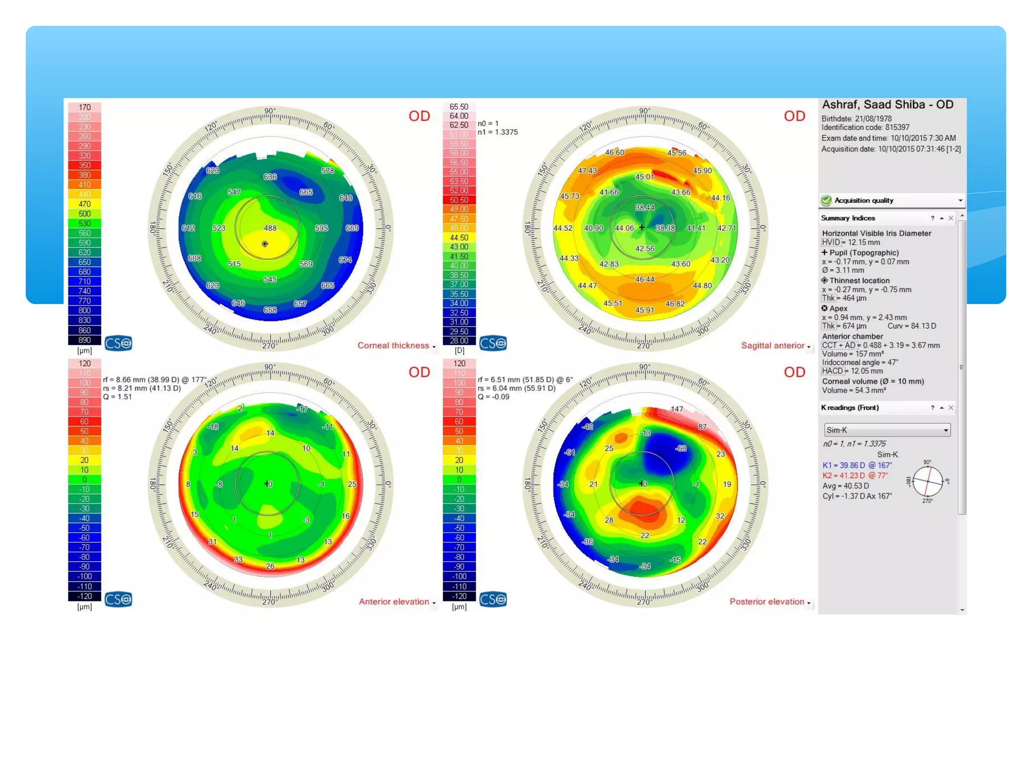 Intracorneal ring-segments-by-femtosecond-tunnel-creation | PPT