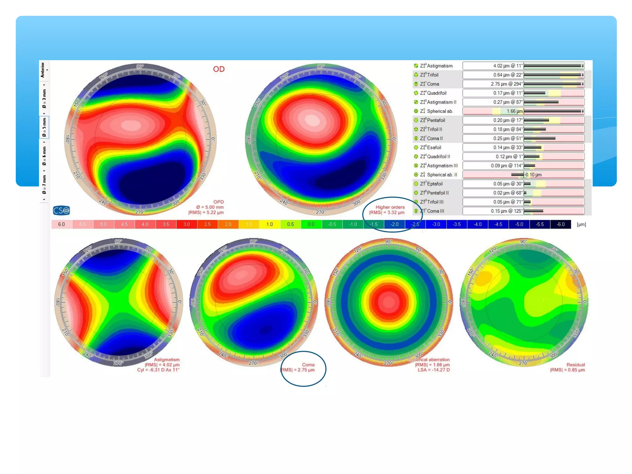 Intracorneal ring-segments-by-femtosecond-tunnel-creation | PPT