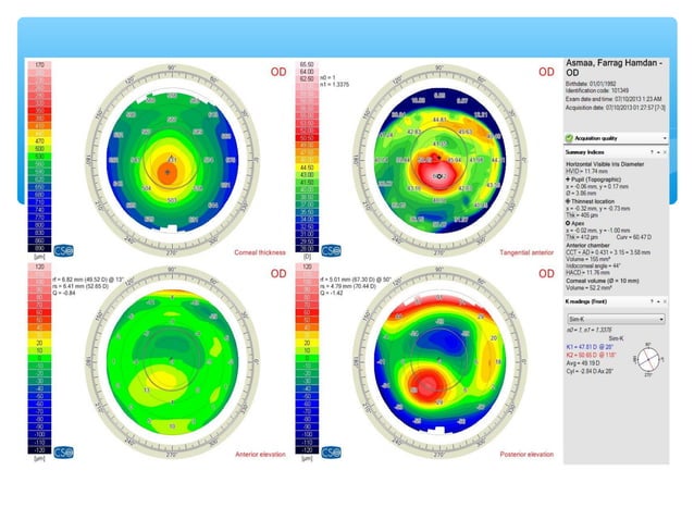 Intracorneal ring-segments-by-femtosecond-tunnel-creation | PPT
