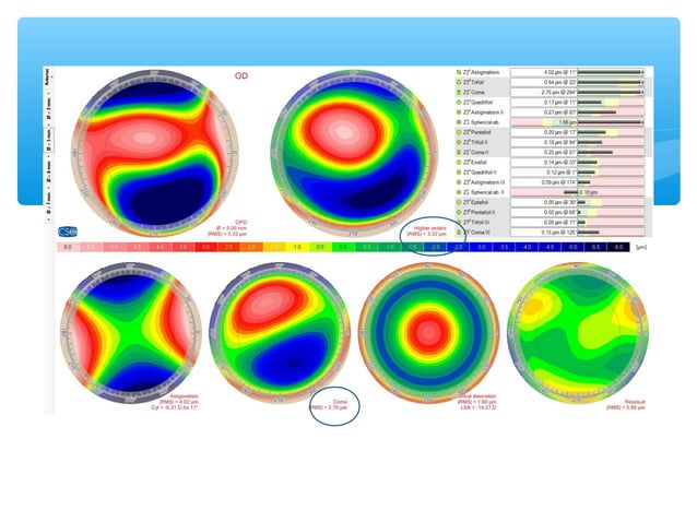 Intracorneal ring-segments-by-femtosecond-tunnel-creation | PPT