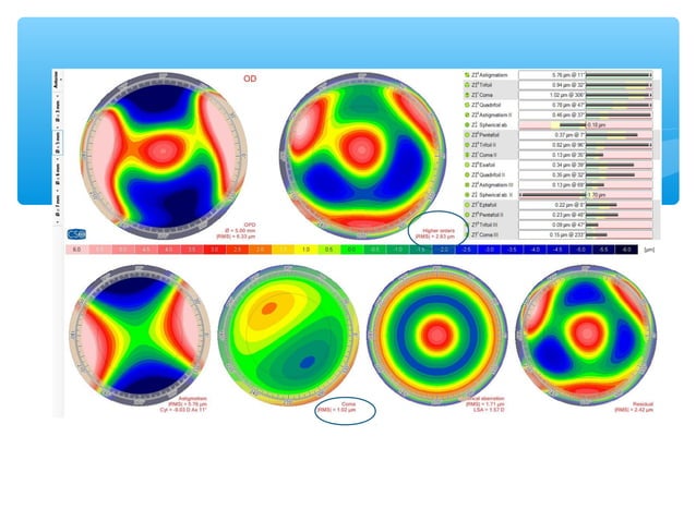Intracorneal ring-segments-by-femtosecond-tunnel-creation | PPT