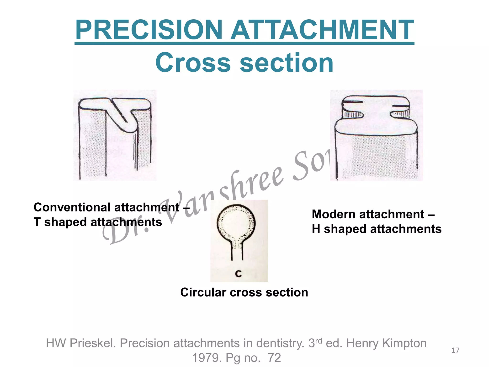 Intracoronal Attachments | PPTX
