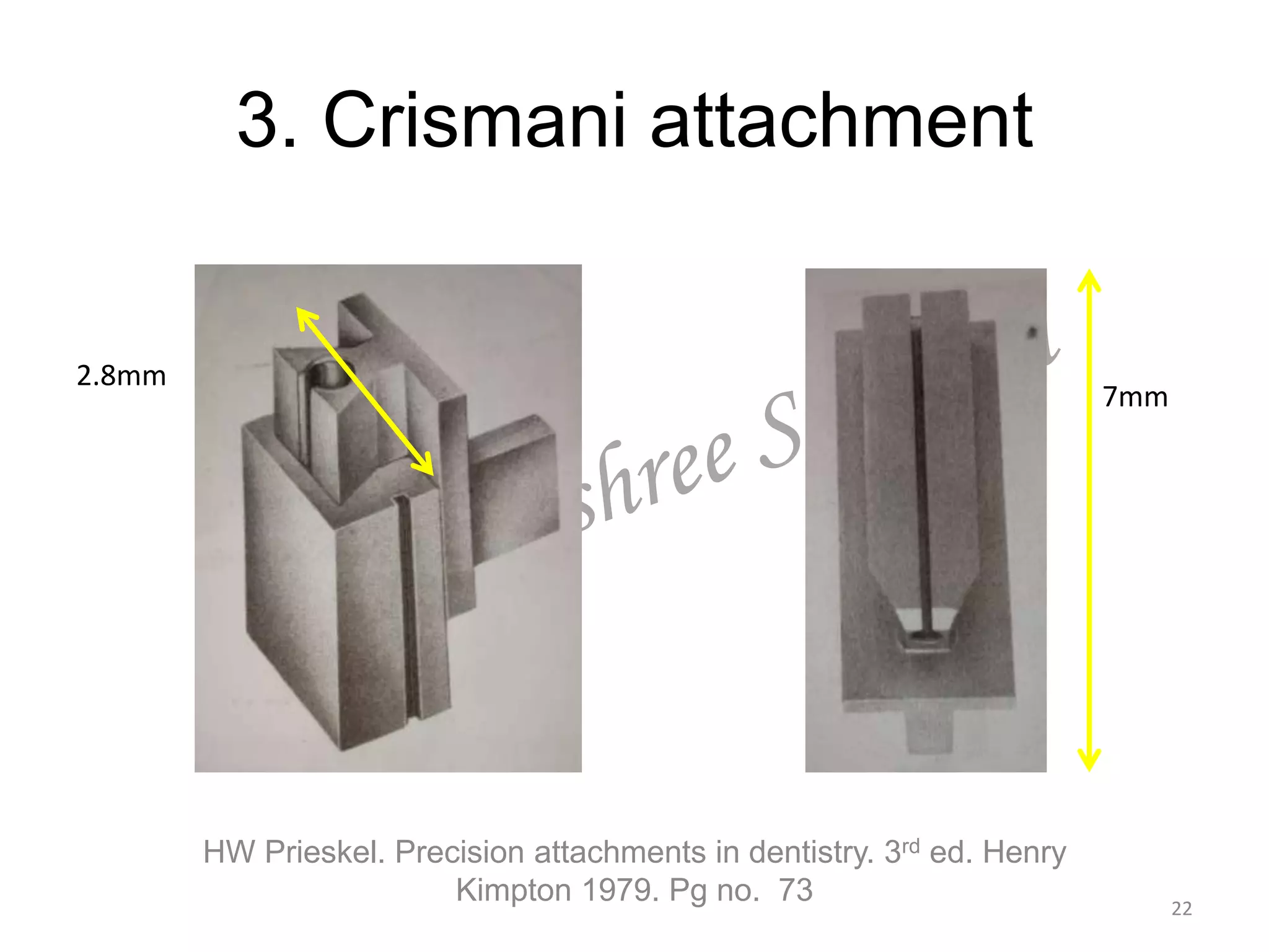 Intracoronal Attachments | PPTX