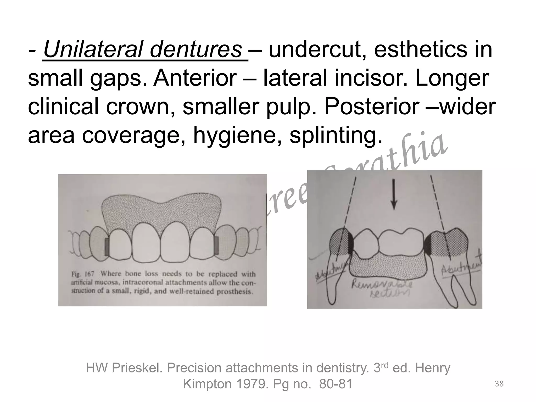 Intracoronal Attachments | PPTX