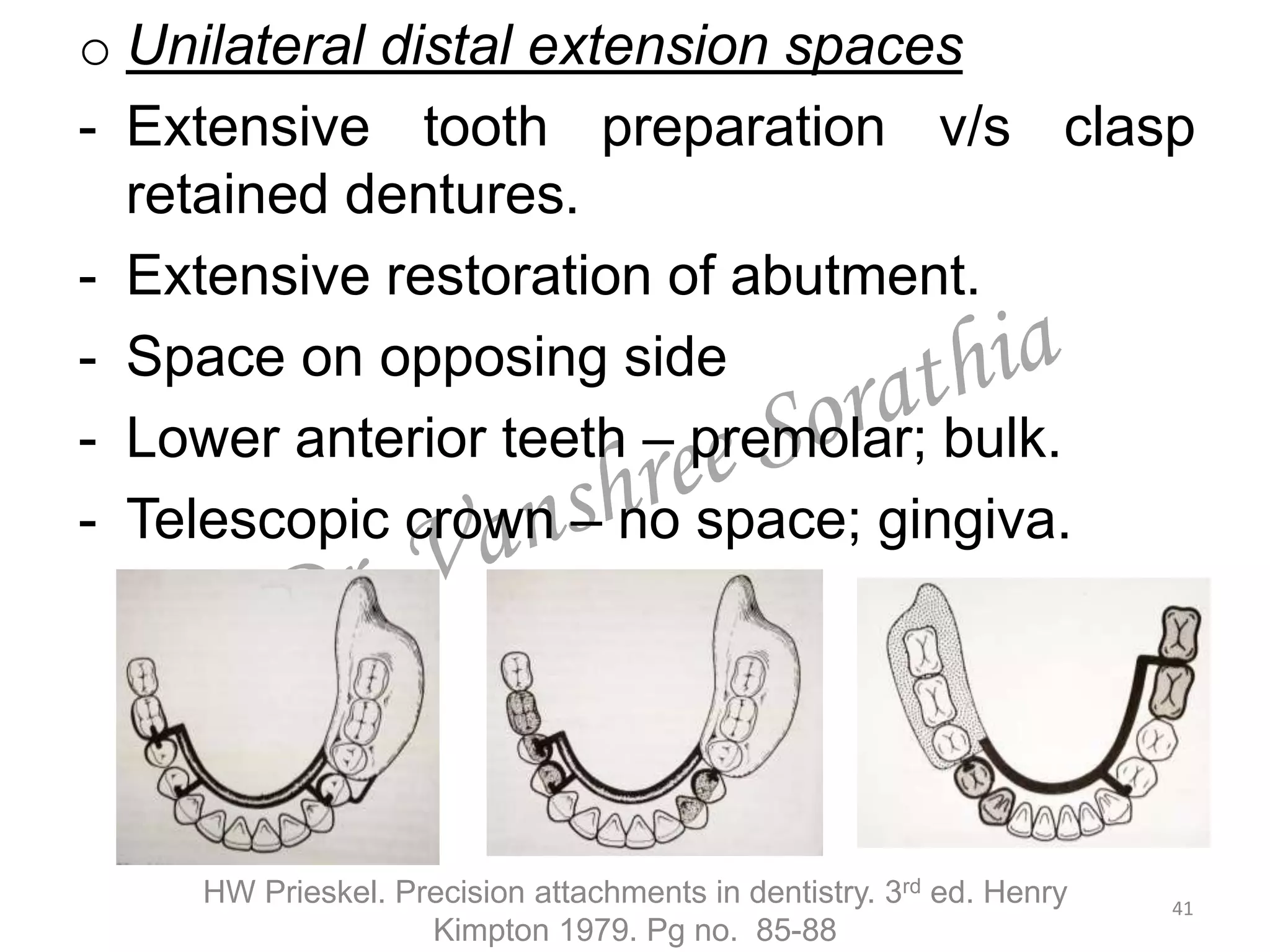 Intracoronal Attachments | PPTX