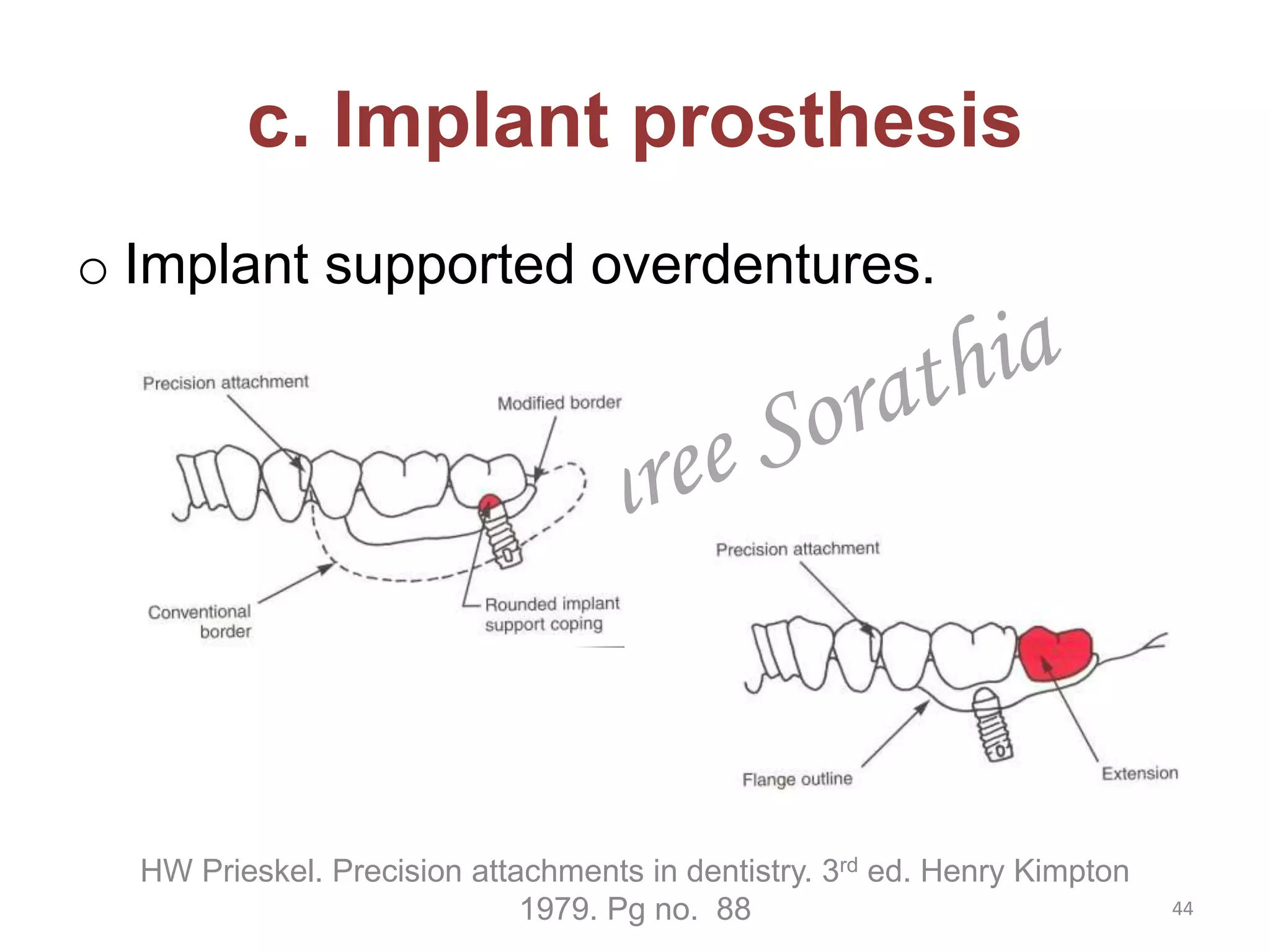 Intracoronal Attachments | PPTX