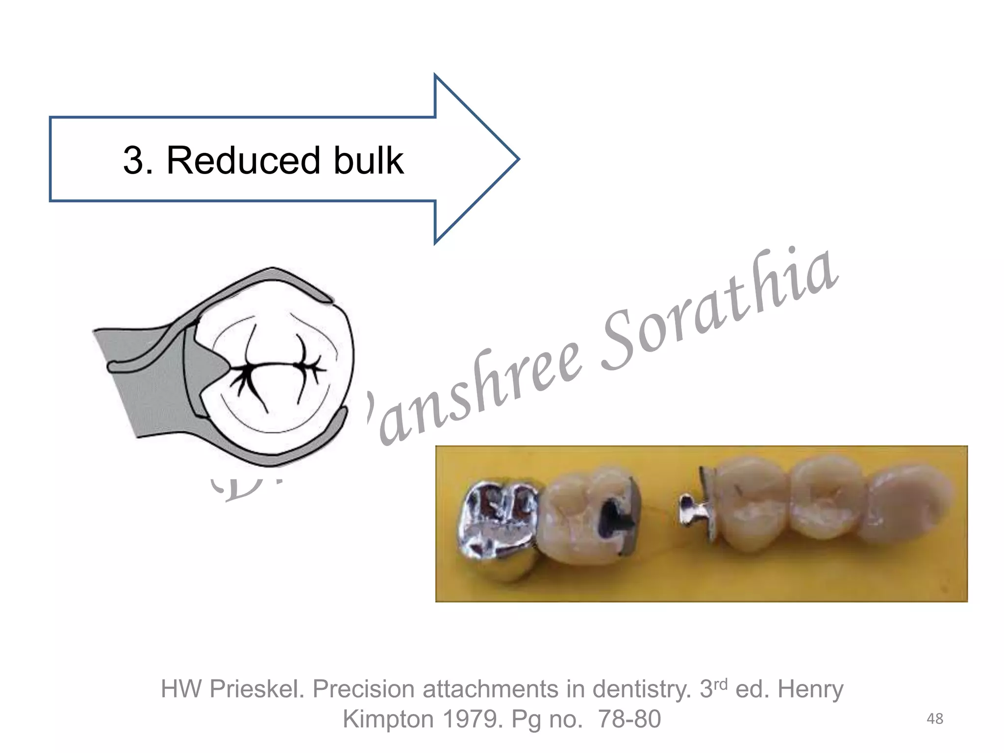 Intracoronal Attachments | PPTX