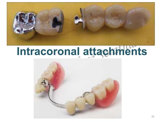Intracoronal Attachments | PPTX
