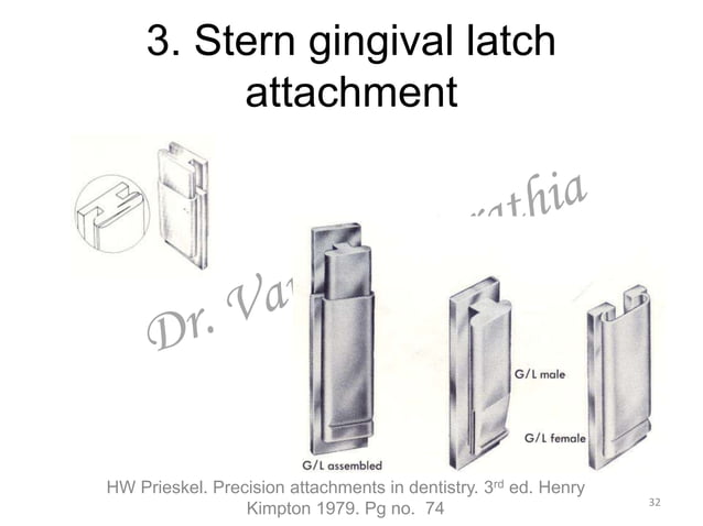 Intracoronal Attachments | PPTX