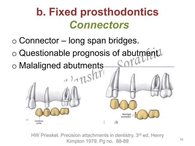 Intracoronal Attachments | PPTX