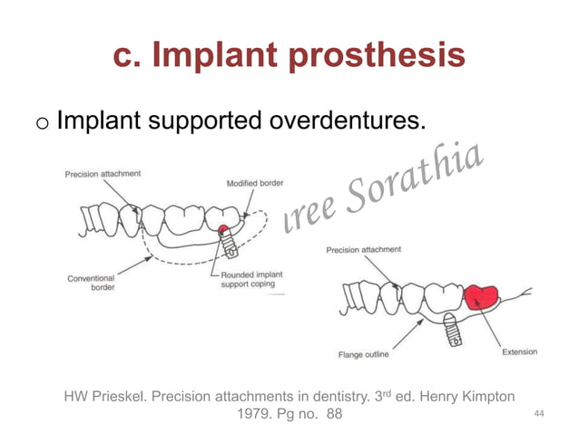 Intracoronal Attachments | PPTX