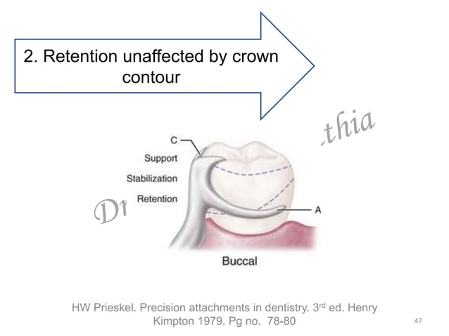 Intracoronal Attachments | PPTX