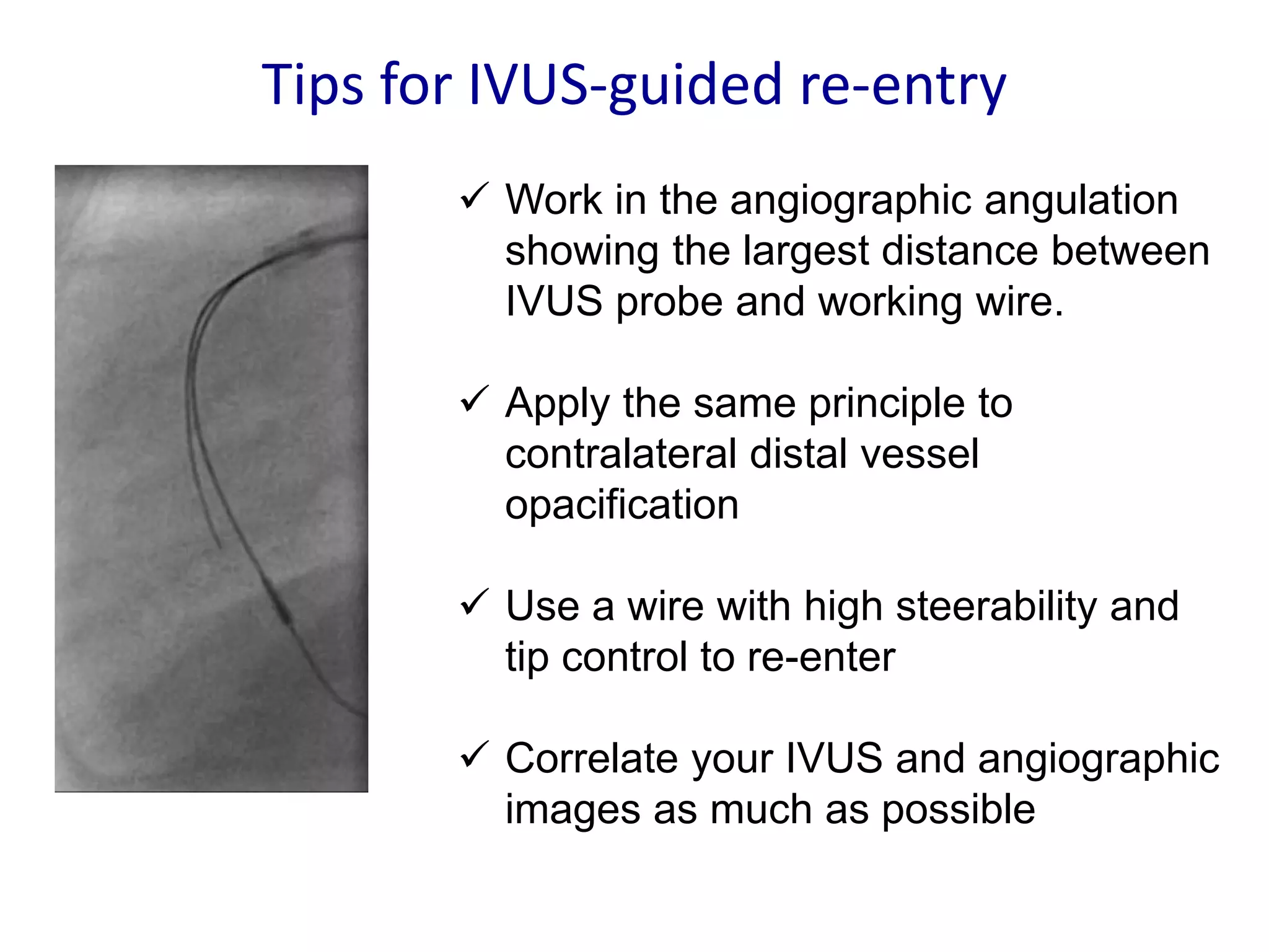 Intracoronary Imaging – when to use, how to use and how to interpret ...