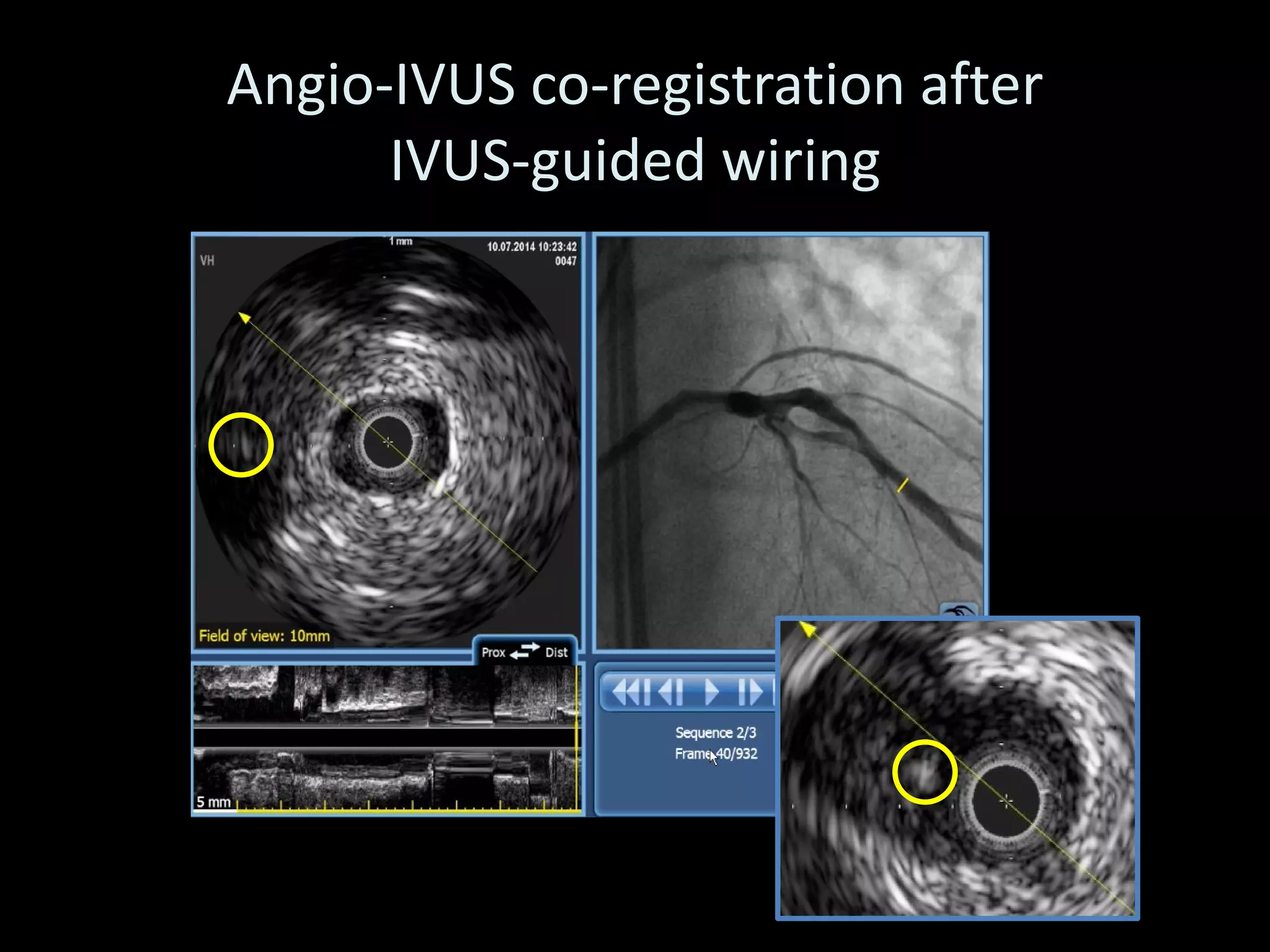 Intracoronary Imaging – when to use, how to use and how to interpret ...