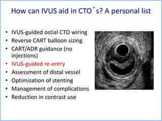 Intracoronary Imaging – when to use, how to use and how to interpret the images | PPT
