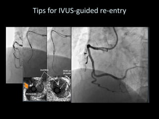Intracoronary Imaging – when to use, how to use and how to interpret ...