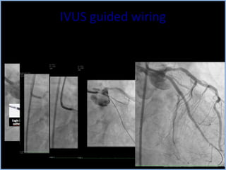 Intracoronary Imaging – when to use, how to use and how to interpret ...