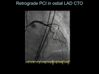 Intracoronary Imaging – when to use, how to use and how to interpret ...