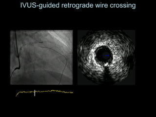 Intracoronary Imaging – when to use, how to use and how to interpret ...