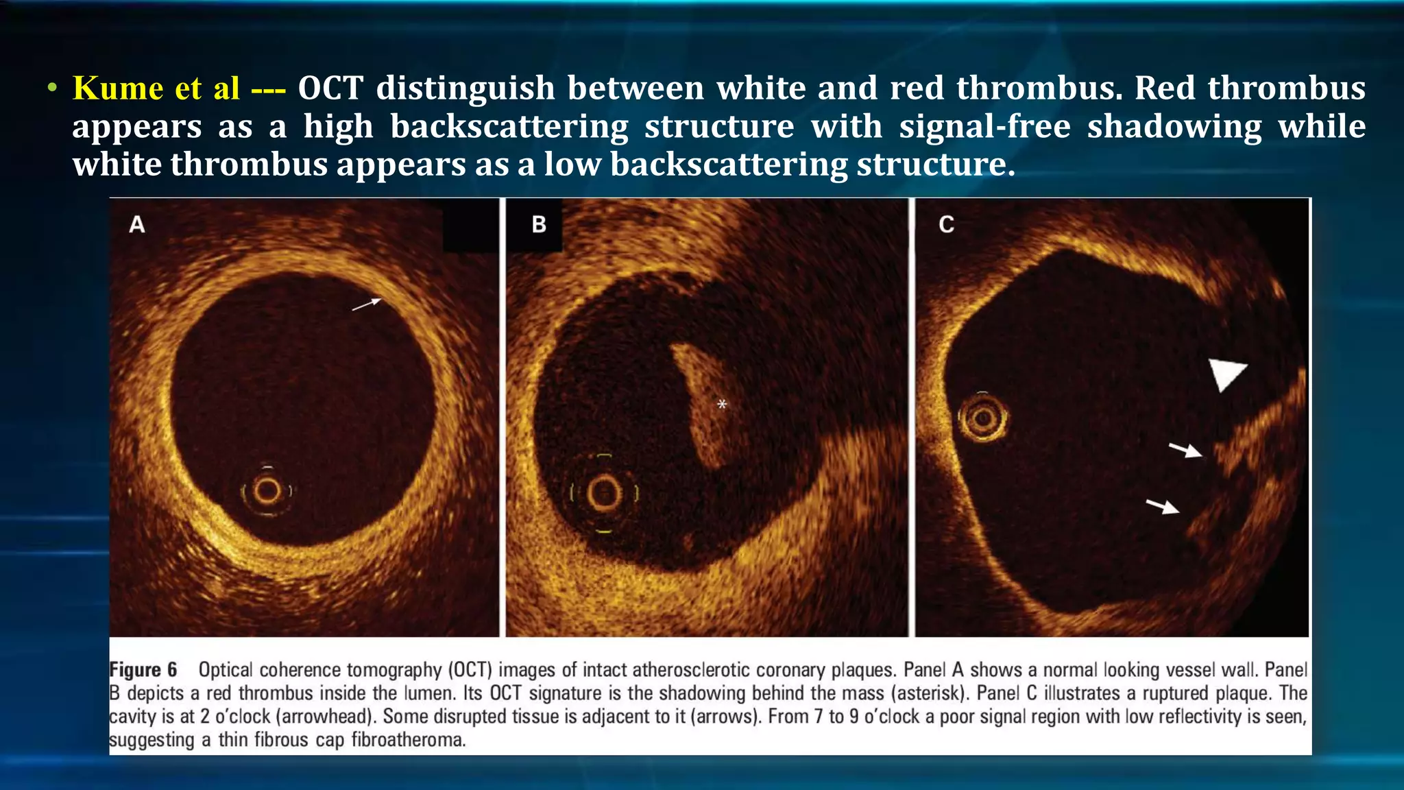 Intracoronary optical coherence tomography | PPTX