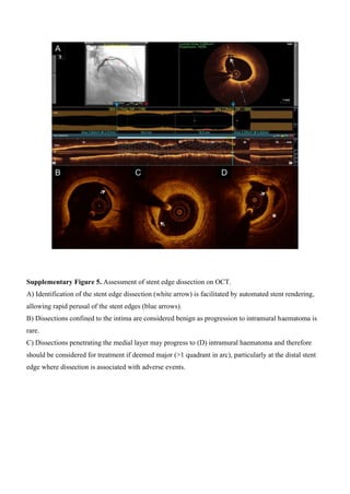 Intracoronary optical coherence tomography | PDF | Heart and ...