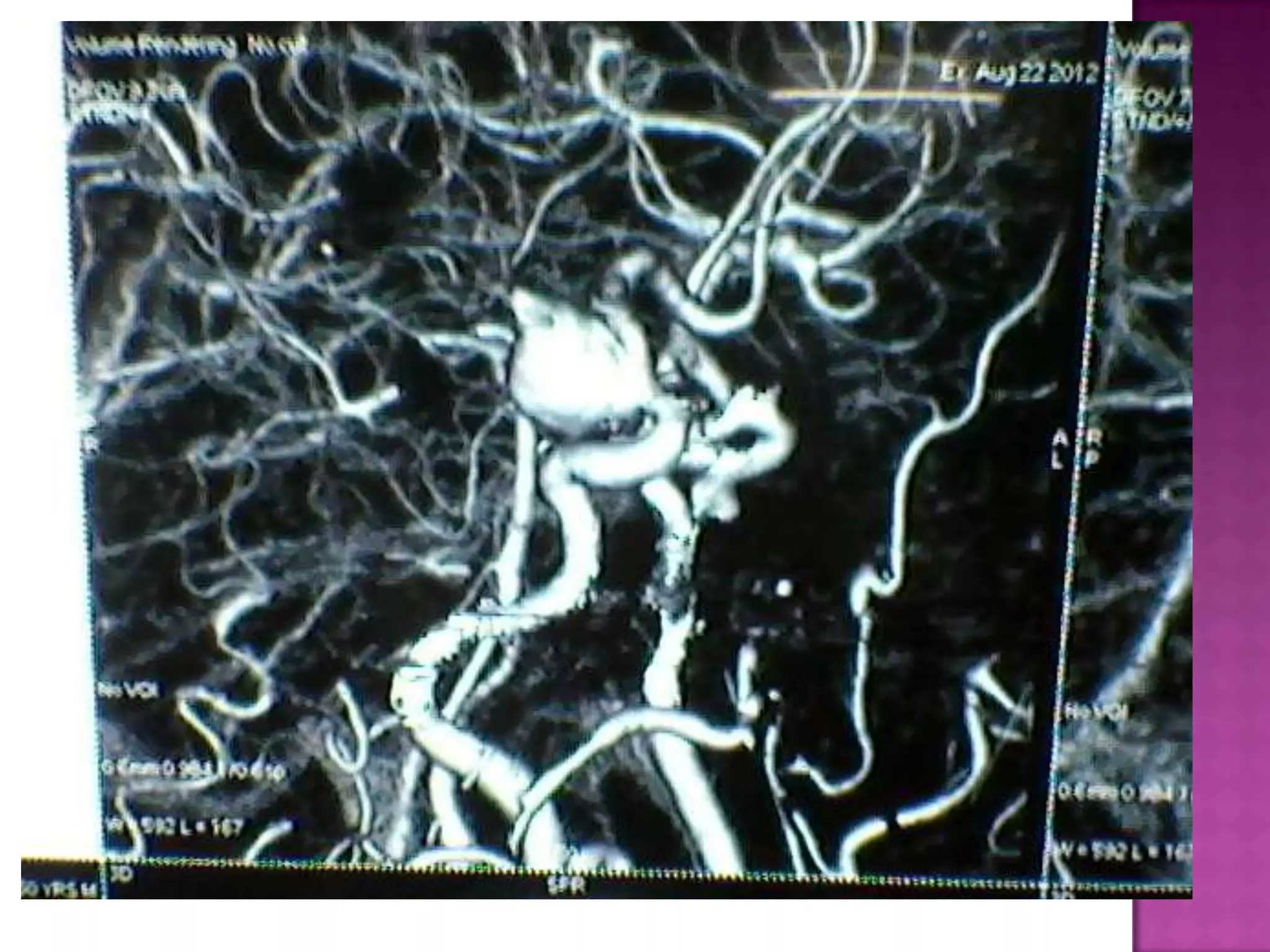 Intracranial Aneurysm Surgery And Anesthesia Ppt
