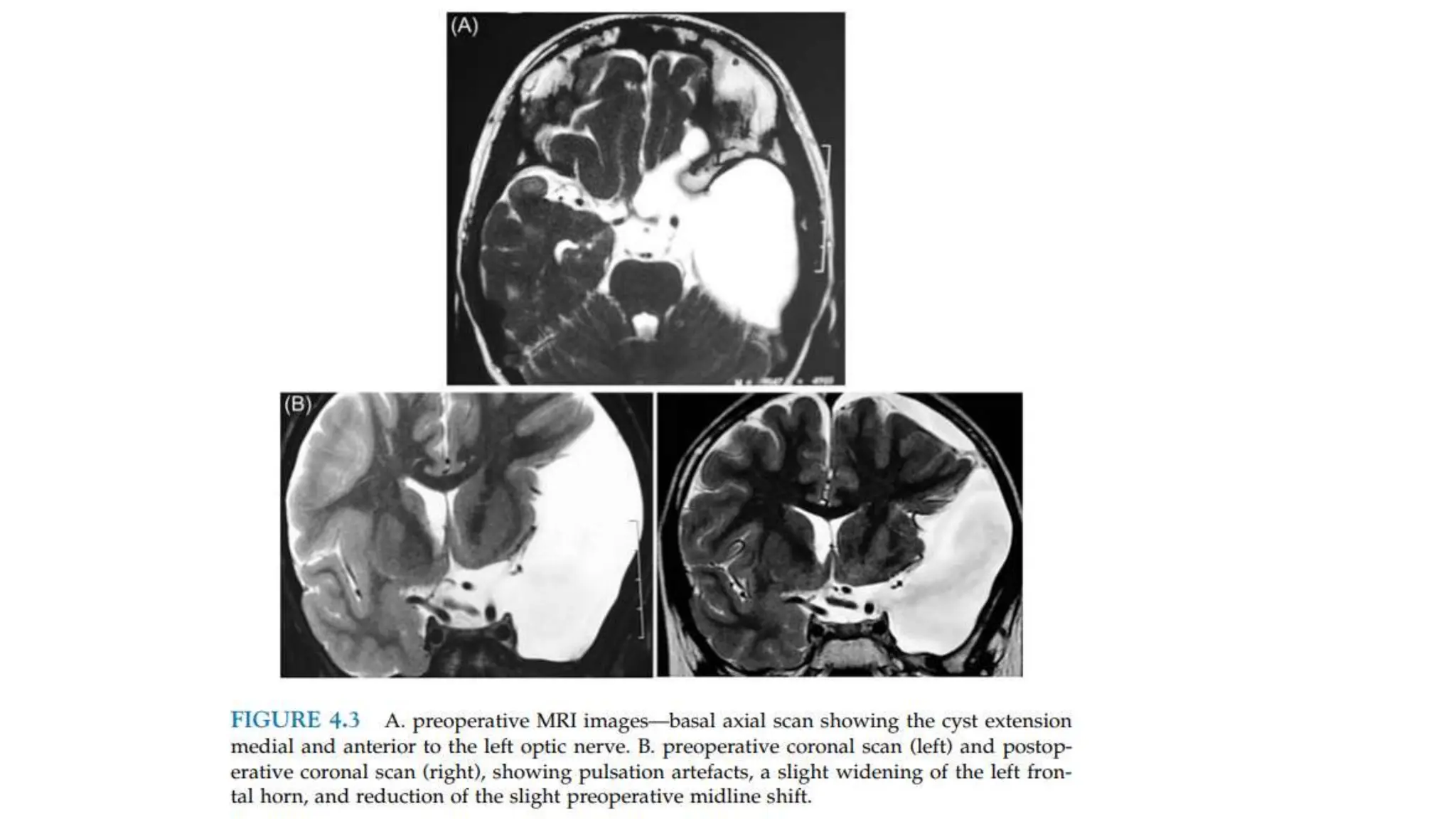 an review on Intracranial arachnoid cyst | PPTX