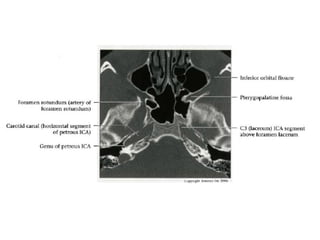 Internal Carotid Artery and Normal Variants | PPT