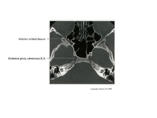 Internal Carotid Artery and Normal Variants | PPT