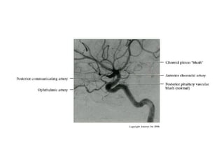 Internal Carotid Artery and Normal Variants | PPT