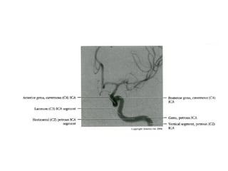 Internal Carotid Artery and Normal Variants | PPT