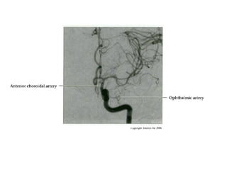 Internal Carotid Artery and Normal Variants | PPT