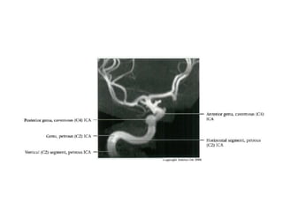 Internal Carotid Artery and Normal Variants | PPT
