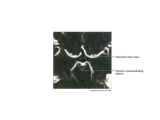 Internal Carotid Artery and Normal Variants | PPT