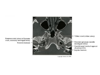 Carotid Petrous Sinus Ct