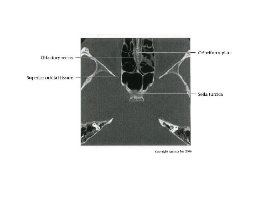 Carotid Artery Variants