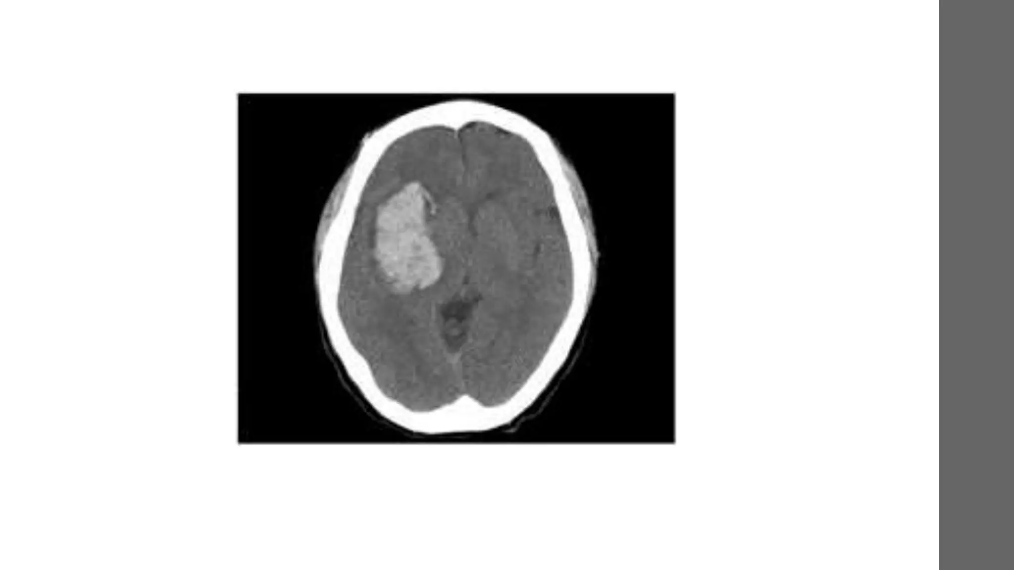 Intracranial bleeding | PPTX