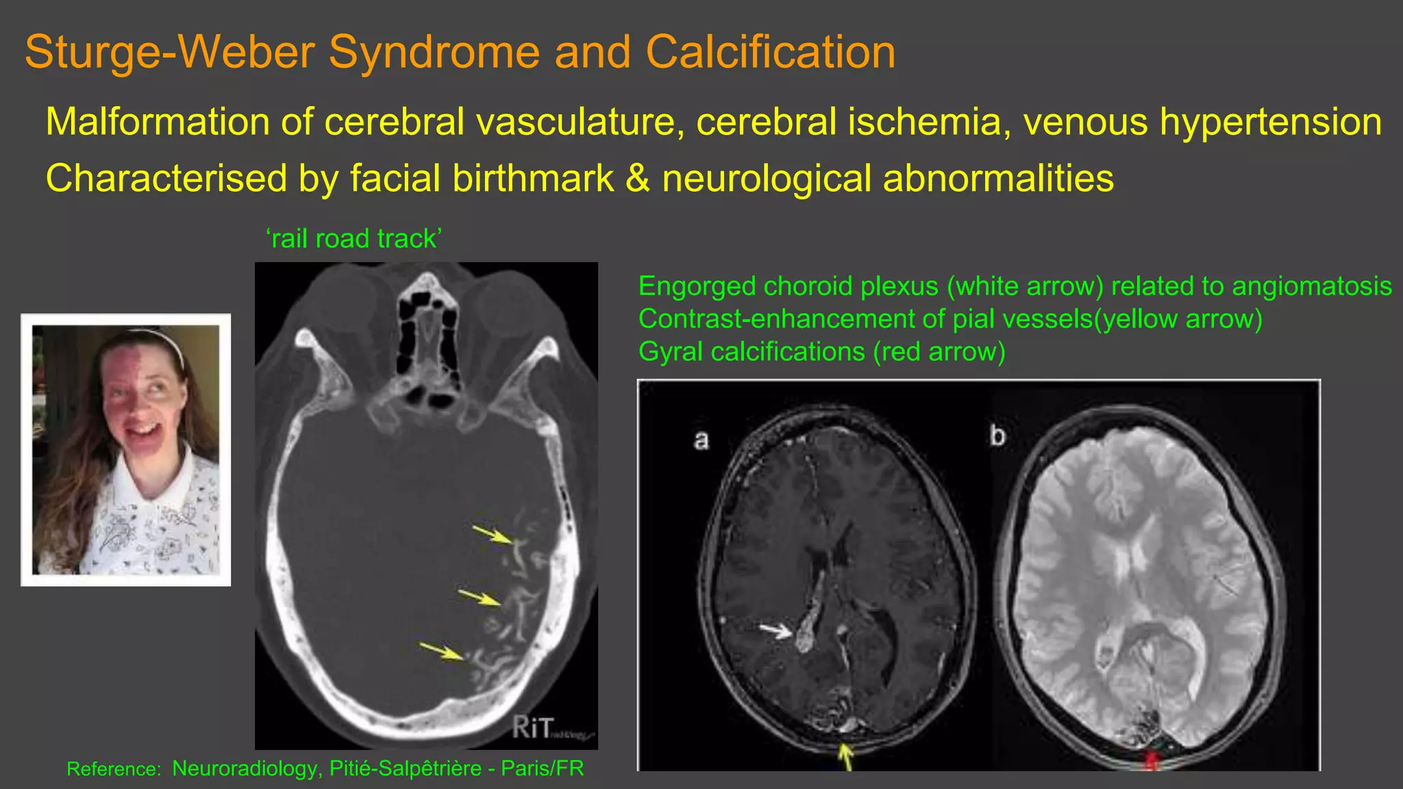 Intracranial Calcification in Cone Beam CT & Medical CT | PPTX