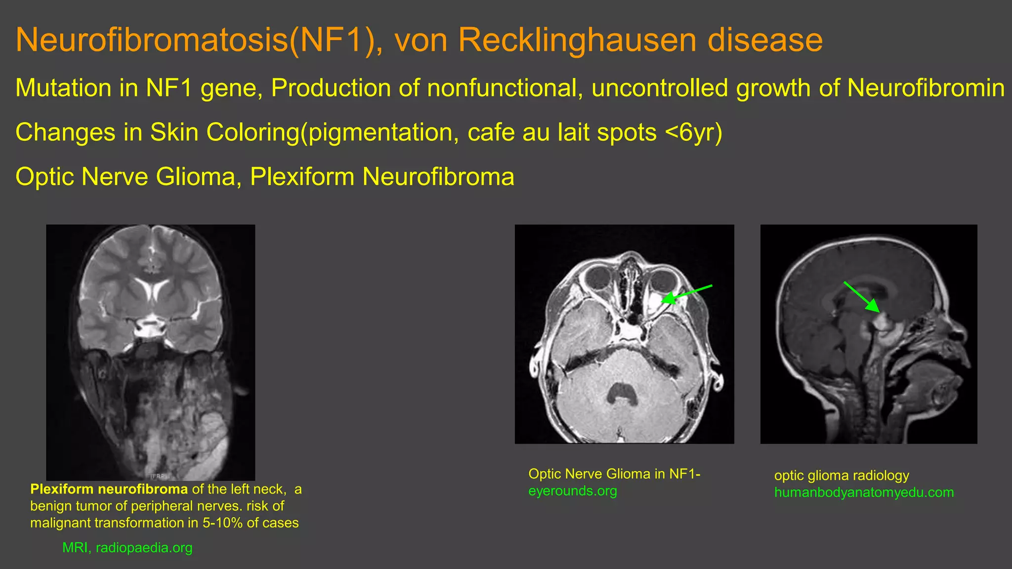 Intracranial Calcification in Cone Beam CT & Medical CT | PPTX