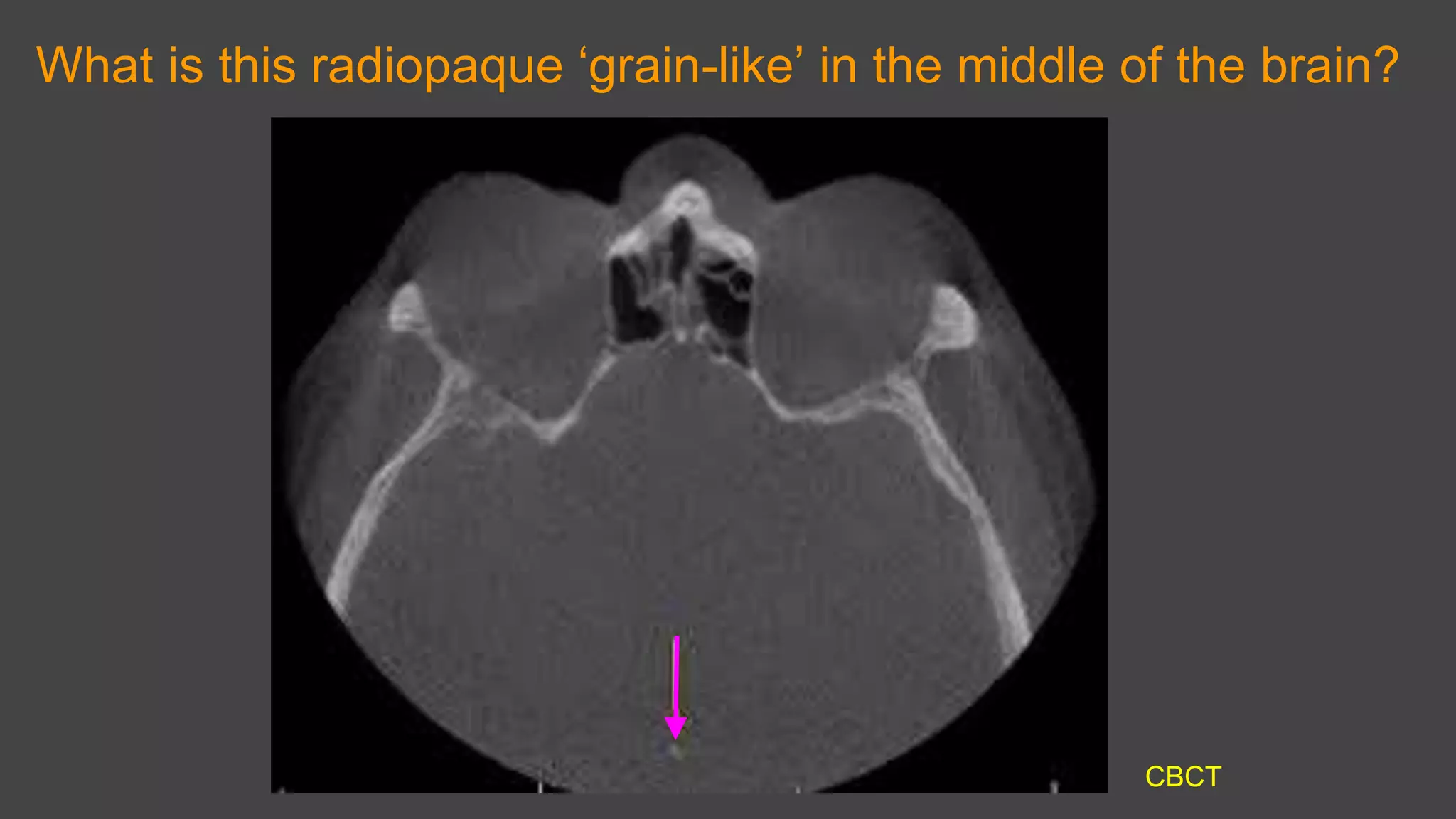 Intracranial Calcification in Cone Beam CT & Medical CT | PPTX