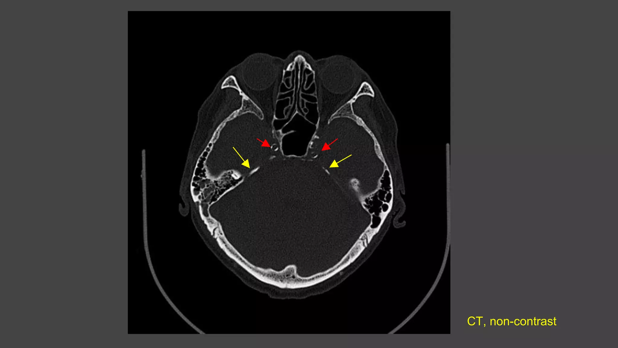 Intracranial Calcification in Cone Beam CT & Medical CT | PPTX