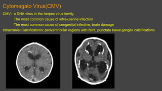 Cmv Periventricular Calcification